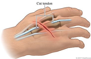 Tendon Laceration in the Hand: Care Instructions | Kaiser Permanente