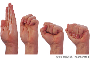 Fractura de dedo: Ejercicios de rehabilitación | Kaiser Permanente