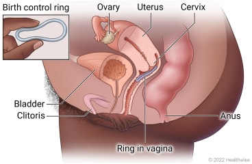 Learning About Birth Control: The Vaginal Ring | Kaiser Permanente